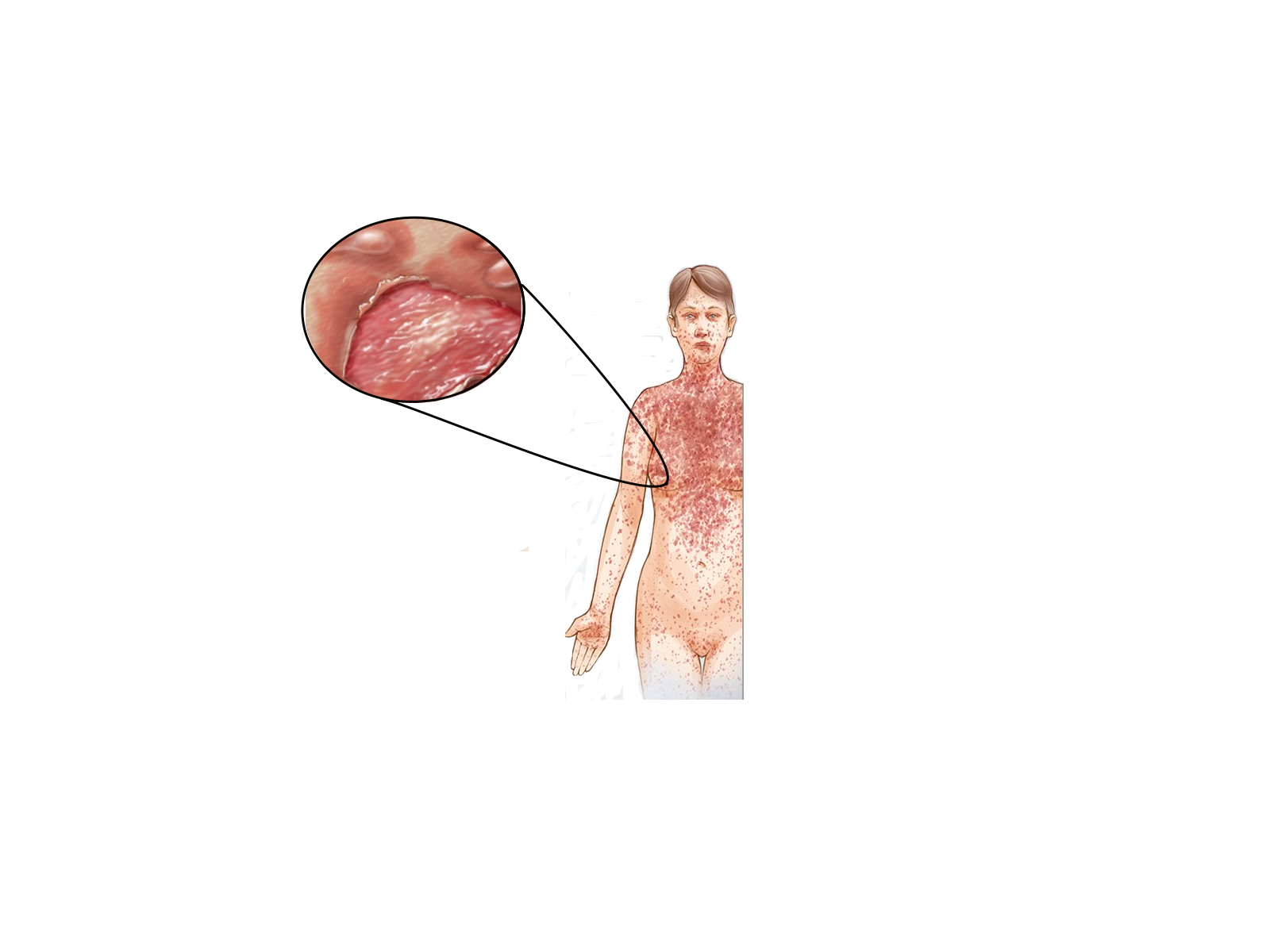 Sindrome de steven- jhonson valen_law22 - Illustrations ART street